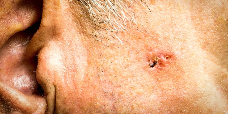 Qué es un epitelioma basocelular y cómo se trata - Blog SaludOnNet