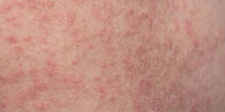 Roseola. Causas, síntomas y tratamiento - Blog SaludOnNet