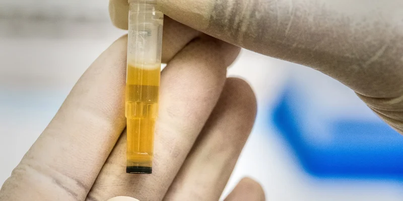 Leucocitos en la orina, ¿qué significa? - Blog SaludOnNet