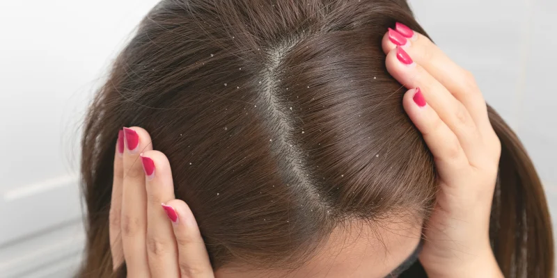 ¿Dermatitis seborreica o caspa? Síntomas y tratamiento - Blog ...