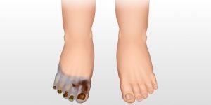 Qué es la gangrena: causas, síntomas y tratamiento - Blog SaludOnNet