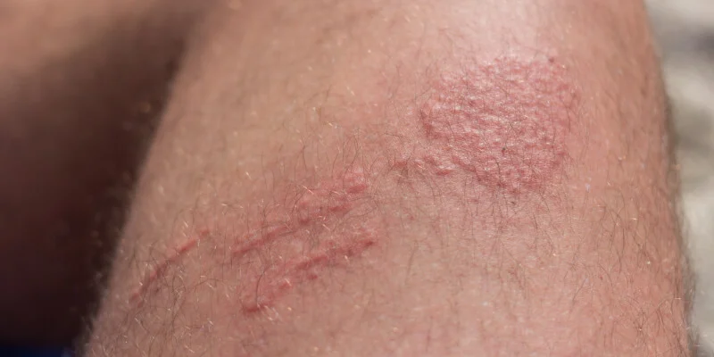 Picaduras de medusas: como son y cómo tratarlas - Blog SaludOnNet