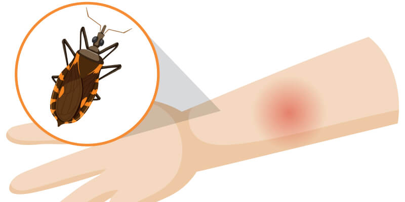 La Enfermedad de Chagas - Blog SaludOnNet