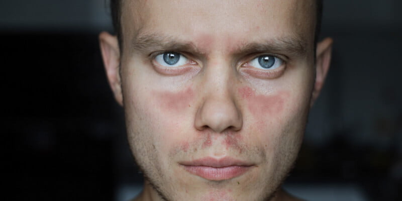 Lupus: causas, síntomas y tratamiento - Blog SaludOnNet