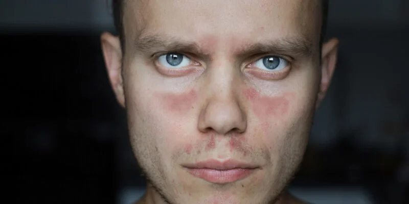 Lupus: causas, síntomas y tratamiento - Blog SaludOnNet