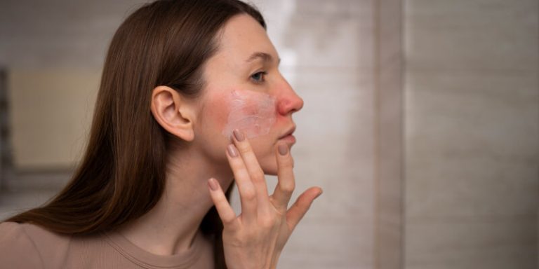 Rosácea: causas, síntomas y tratamiento - Blog SaludOnNet