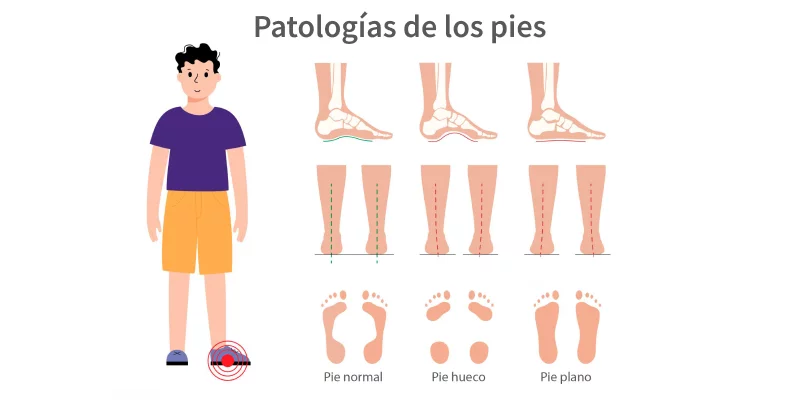 Los pies planos, su causa y tratamiento - Blog SaludOnNet