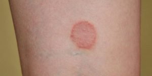 Qué es el liquen plano y qué síntomas tiene - Blog SaludOnNet