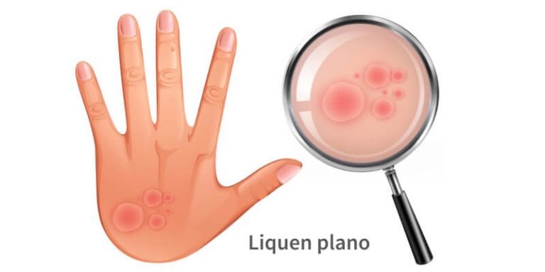 Qué es el liquen plano y qué síntomas tiene - Blog SaludOnNet