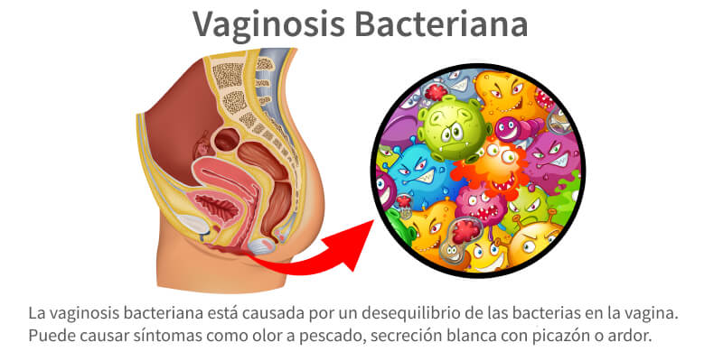 Qué es la vaginosis bacteriana - Blog SaludOnNet