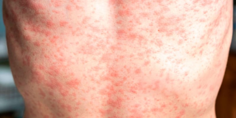 Sarampión: causas, síntomas, prevención y tratamiento - Blog SaludOnNet